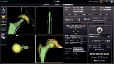 Αρθροπλαστική Ισχίου - Ρομποτική αρθροπλαστική ισχίου με το ρομποτικό ...
